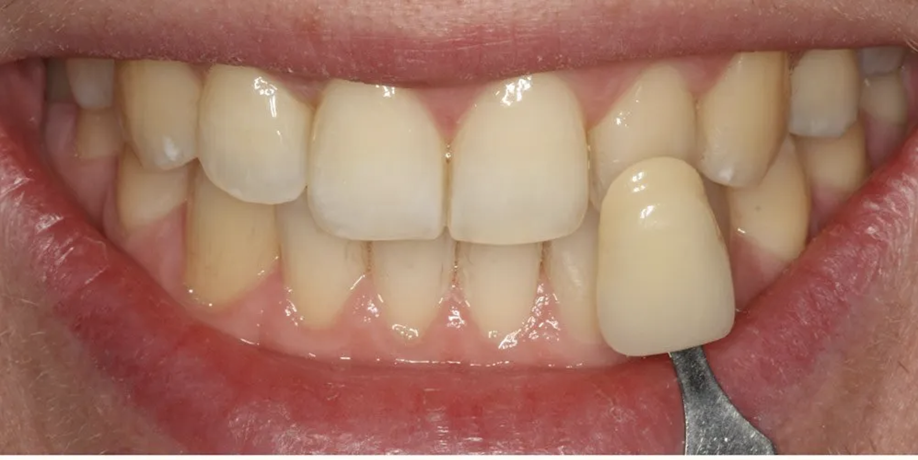 Teeth Whitening UK - Professional At-Home Tooth Whitening from £350